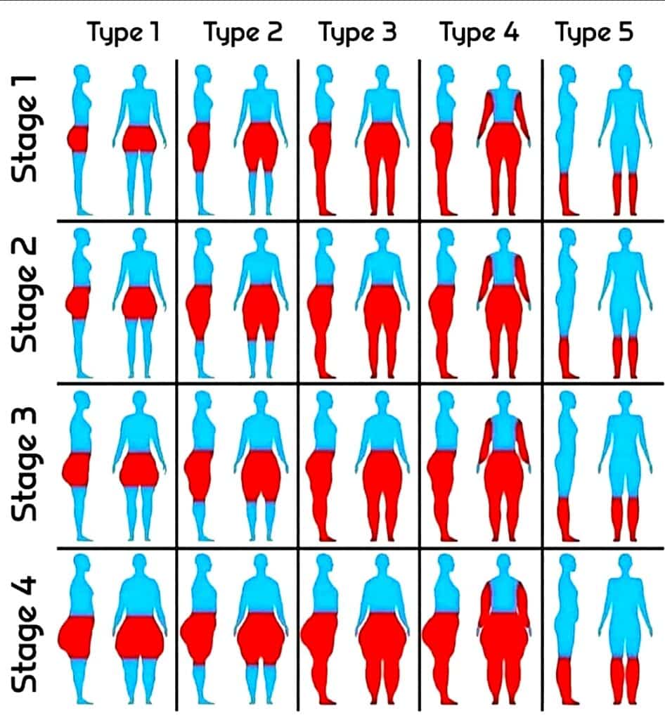 Diagnosis of lipedema - Lipoedema clinic